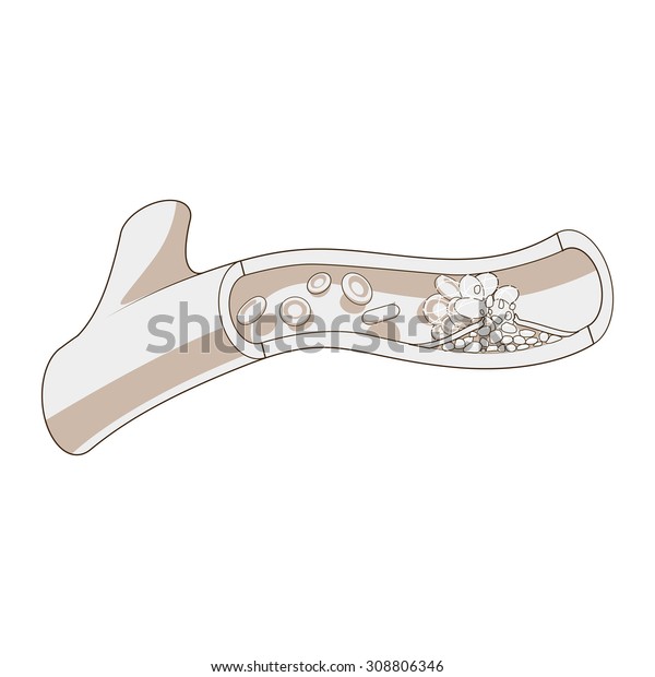 Blood Vessel Clot Thrombus Vector Illustration Stock Vector (Royalty ...