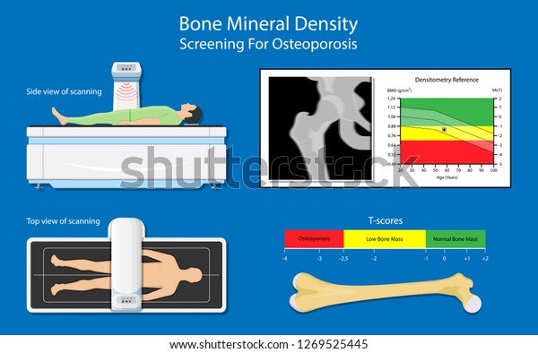 Bone Mineral Density Bmd Osteoporosis Dual Stock Vector (Royalty Free ...