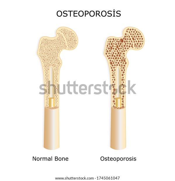 Bone Structure Osteoporosis Patients Stock Vector (Royalty Free) 1745061047