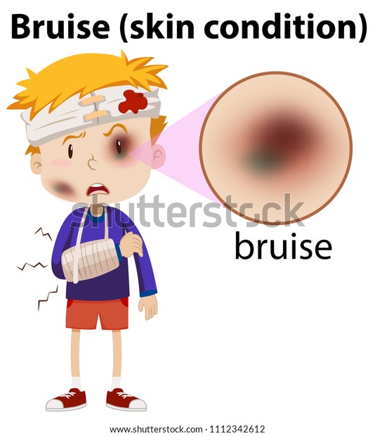 Boy Having Bruise On Face Illustration Stock Vector (Royalty Free ...