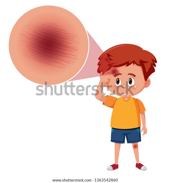 Boy Scab On Forehead Illustration: immagine vettoriale stock (royalty ...