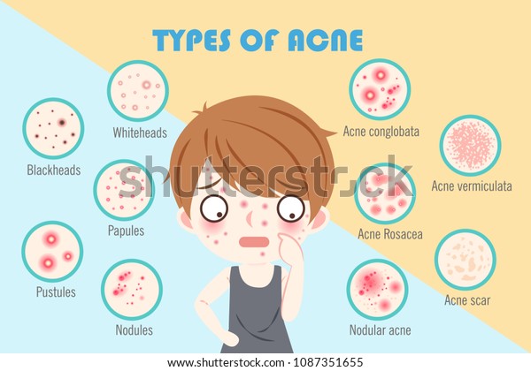 Boy Types Acne On Blue Background 库存矢量图（免版税）1087351655
