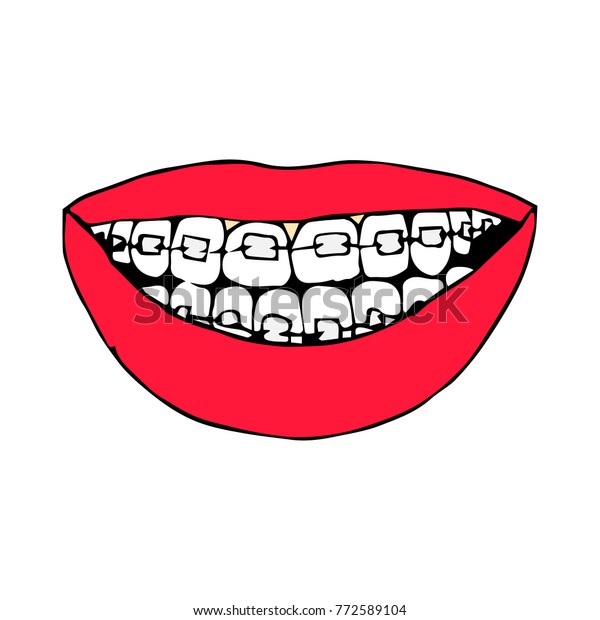 Braces On Teeth Vector Illustration Doodle Stock Vector (Royalty Free ...