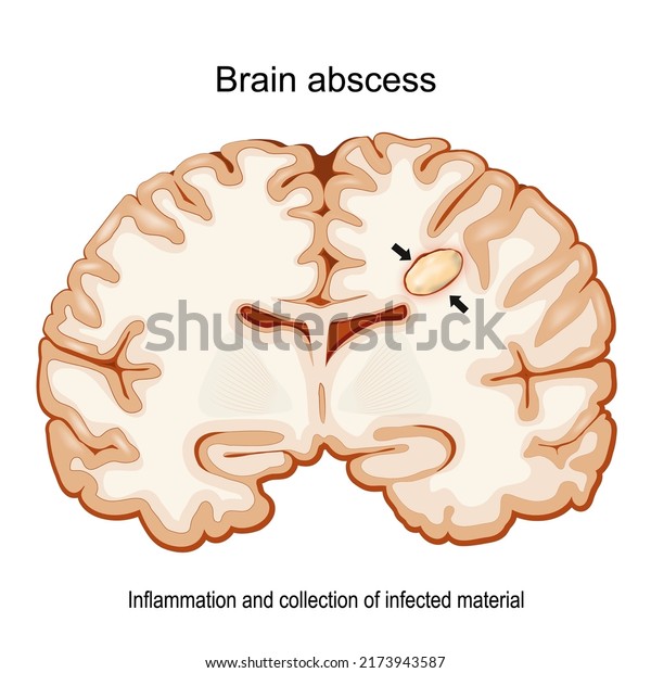 Brain Abscess Cerebral Abscess Infectious Diseases Stock Vector ...
