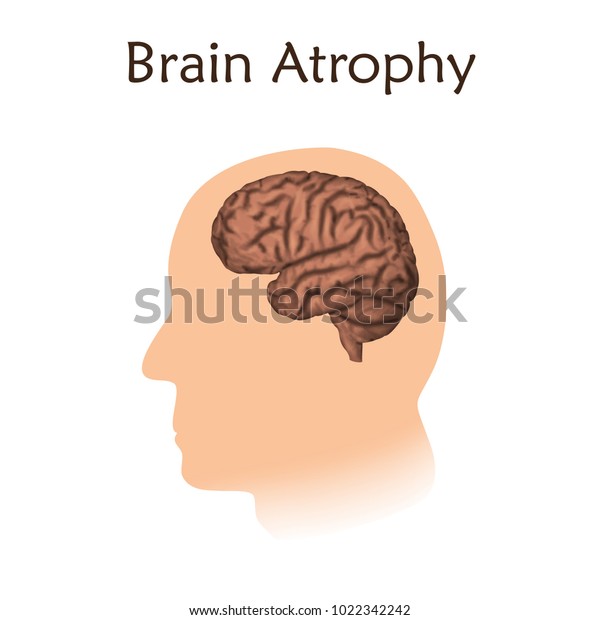 Brain Atrophy White Background Silhouette Head: เวกเตอร์สต็อก (ปลอดค่า ...