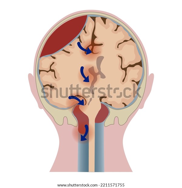 Brain Hematoma Tissue Distortion Sectioned Head: เวกเตอร์สต็อก (ปลอดค่า ...