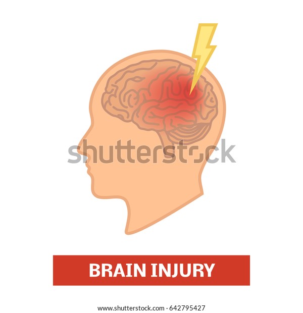 Brain Injury Concept Simple Cartoon Vector Stock Vector (Royalty Free ...