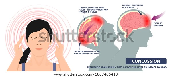 Brain Injury Mild Post Head Bleed Stock Vector (Royalty Free) 1887485413