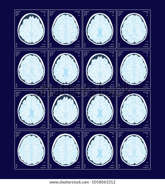 Brain Mri Scanvector Illustration: เวกเตอร์สต็อก (ปลอดค่าลิขสิทธิ์ ...