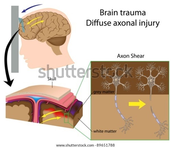 Brain Trauma Axon Shear Car Accident: Vector có sẵn (miễn phí bản quyền ...