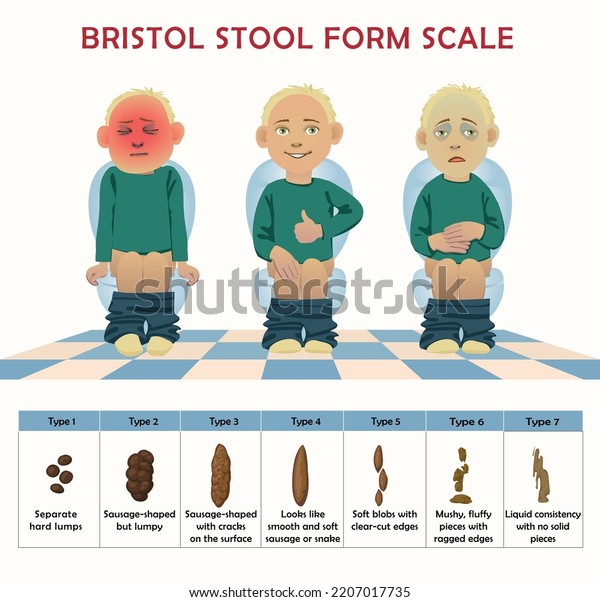 Bristol Stuhl Form Skala Infografiken, medizinische: Stock-Vektorgrafik (Lizenzfrei) 2207017735 ...