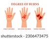 Burnt Hand: Over 10,706 Royalty-Free Licensable Stock Photos | Shutterstock