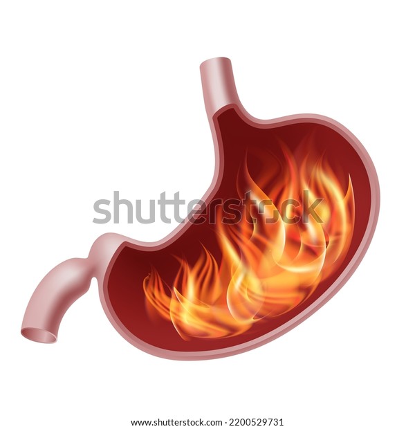 Burning Stomach Realistic Human Organ Internal Stock Vector (Royalty ...