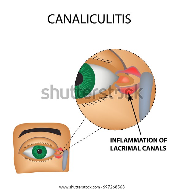Canaliculitis Inflammation Lacrimal Canals Structure Eye Stock Vector ...