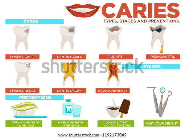 Vektor Stok Caries Types Stages Prevention Poster Text (Tanpa Royalti) 1192173049 | Shutterstock