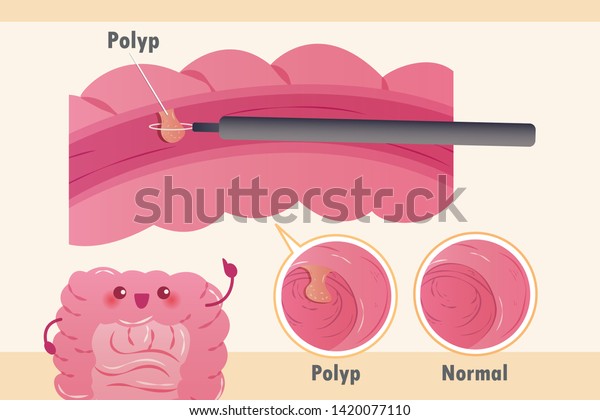 Cartoon Intestine Introduce Polypectomy Using Colonoscopy: стоковая ...