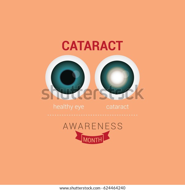 Cataract Awareness Month Design Vector Stock Vector (Royalty Free ...