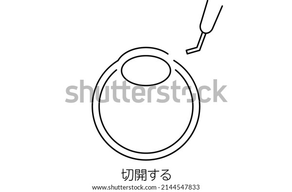 Vektor Stok Cataract Surgery Process Illustration Line Drawing (Tanpa ...