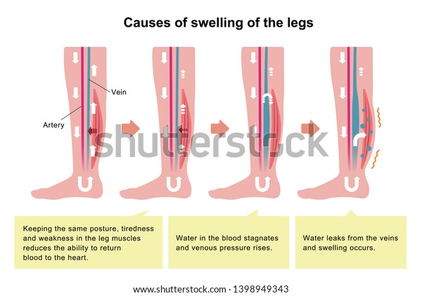 Cause Swellingedema Legs Flat Illustration Explanation Stock Vector ...