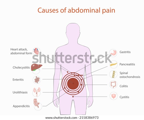 Stock vektor „Causes Abdominal Pain Vector Medical Diagram“ (bez ...