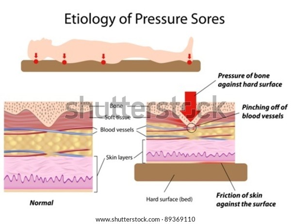 Causes Pressure Sores Stock Vector (Royalty Free) 89369110