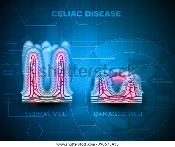 Celiac Disease Affected Small Intestine Villi Stock Vector (Royalty ...