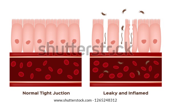 Celiac Disease Small Intestine Lining Damage Stock Vector (Royalty Free ...