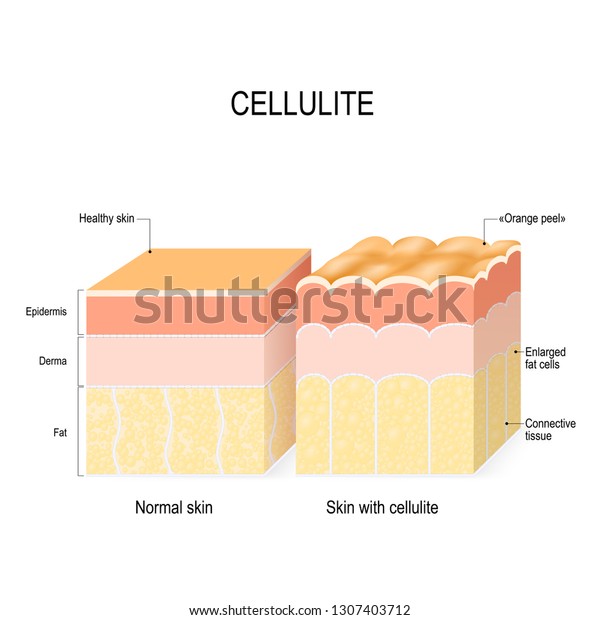 Cellulite Cross Section Healthy Skin Orange Stock Vector (Royalty Free ...