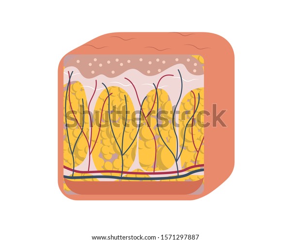 Cellulite Formation Vector Illustration Diagram Medical Stock Vector ...