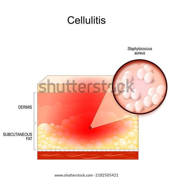 17,538 Cellulitis Images, Stock Photos & Vectors | Shutterstock