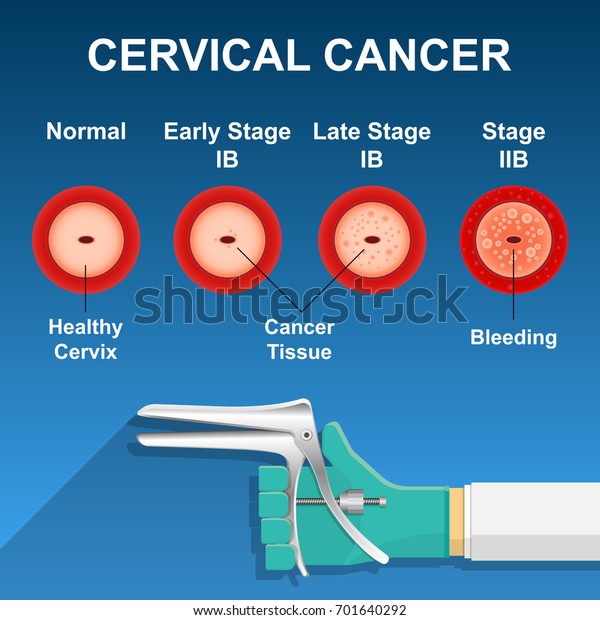 Cervical Cancer Screen Testing Examine Doctor: vector de stock (libre ...