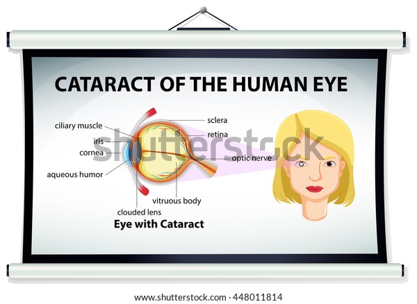 Chart Showing Cataract Human Eye Illustration Stock Vector (Royalty ...