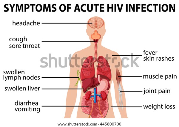 Chart Symtoms Acute Hiv Infection Illustration Stock Vector Royalty