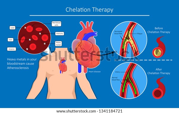Chelation Therapy Lead Mercury Iron Acid Stock Vector (Royalty Free ...