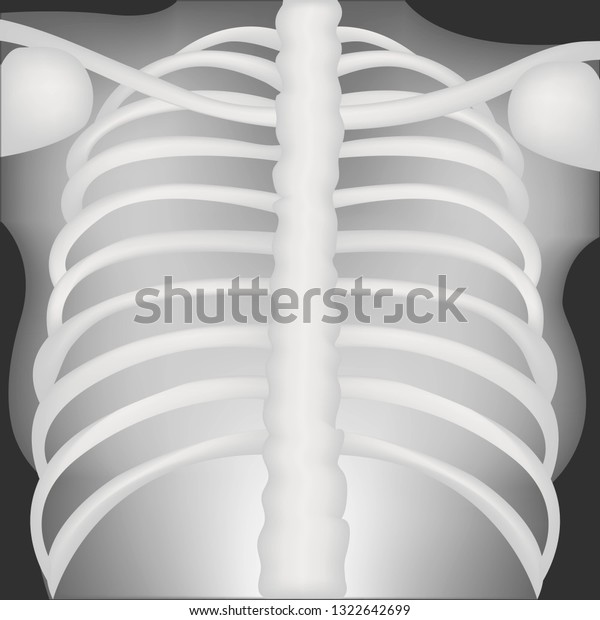 Chest Xrays Medical Vector Illustration: vetor stock (livre de direitos ...