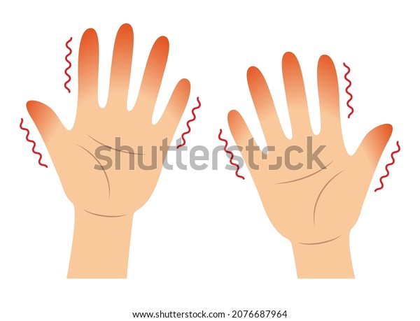 Chilblains Frostbite On Fingertips Red Swollen: เวกเตอร์สต็อก (ปลอดค่า ...