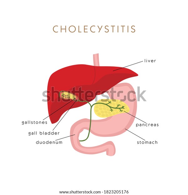 Cholecystitis Inflammation Gallbladder Bile Ducts Gallstones: เวกเตอร์ ...