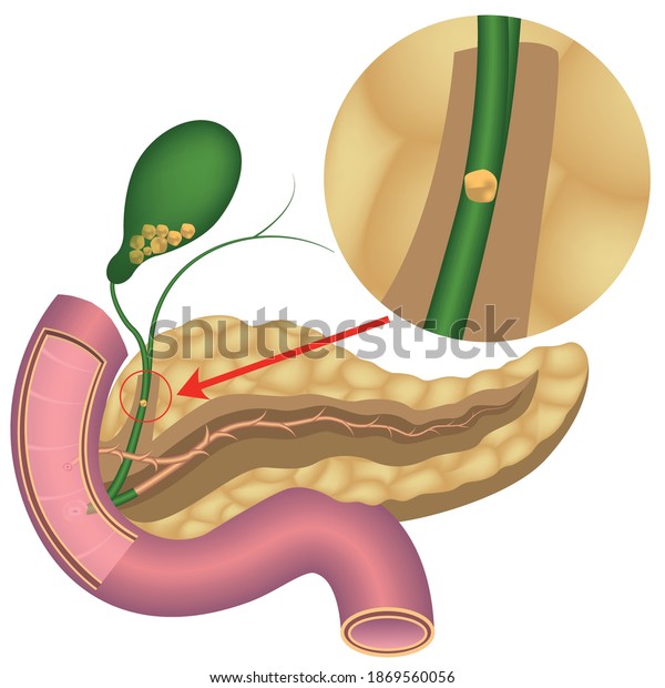 Cholelithiasis Formations Gallbladder Blockage Bile Duct: เวกเตอร์สต็อก ...