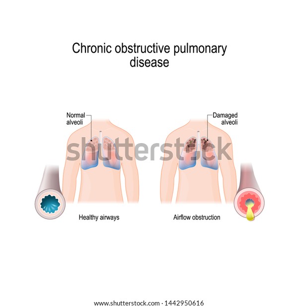 Chronic Obstructive Pulmonary Disease Copd Vector Stock Vector (Royalty ...