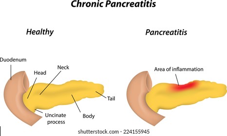 Ilustrasi Stok Acute Pancreatitis Acute Interstitial Pancreatitis Acute ...