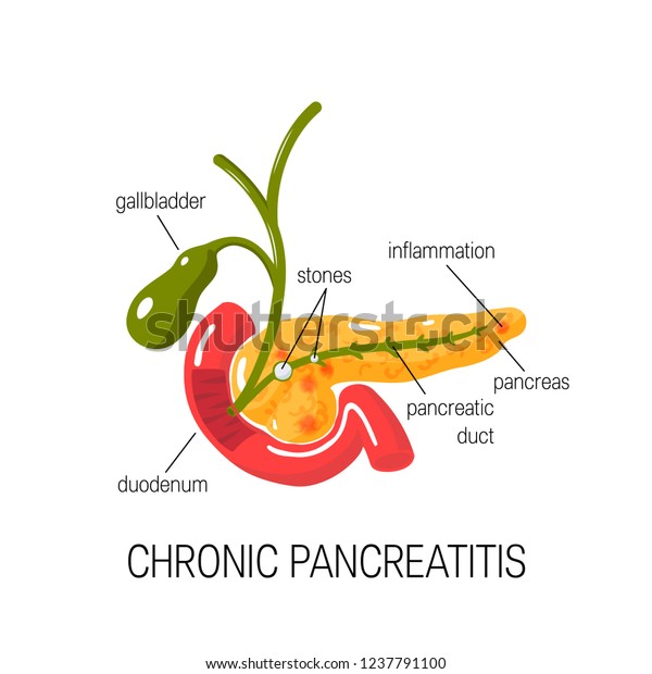 Chronic Pancreatitis Concept Medical Vector Illustration Stock Vector ...