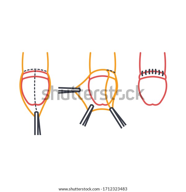 Circumcision Line Icon Vector Illustration Stock Vector (Royalty Free ...
