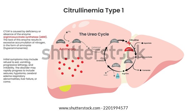 Citrullinemia Type 1 Ass1 Deficiency Informational Stock Vector ...