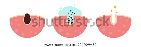 Cleaning Clogged Pores Vector Illustration Skin Stock Vector (Royalty ...