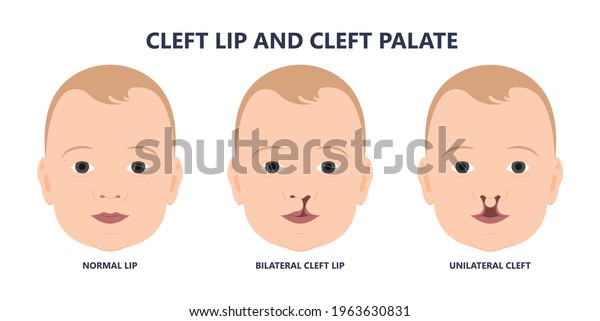 Cleft Lip Birth Defect Baby Face Stock Vector (Royalty Free) 1963630831