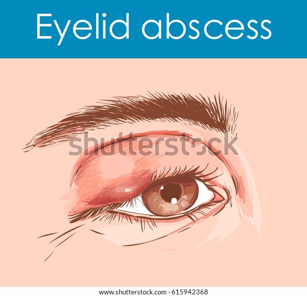 Close Eye Infected Eyelid Stock Vector (Royalty Free) 615942368 ...