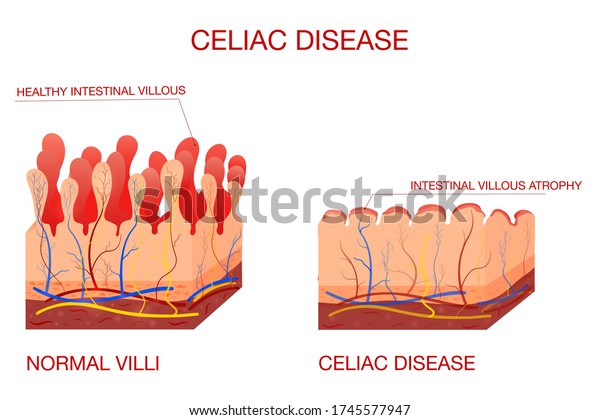 Coeliac Disease Celiac Disease Small Bowel Stock Vector (Royalty Free ...