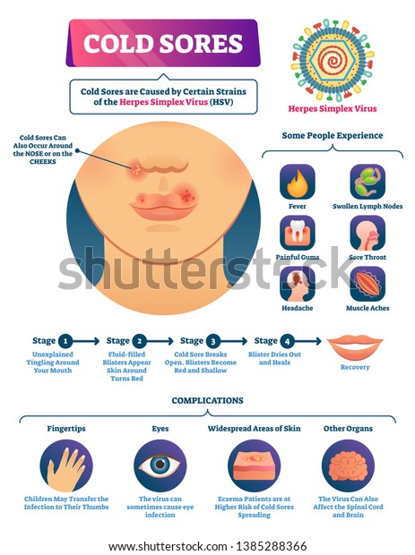 Cold Sores Vector Illustration Medical Labeled 库存矢量图（免版税）1385288366