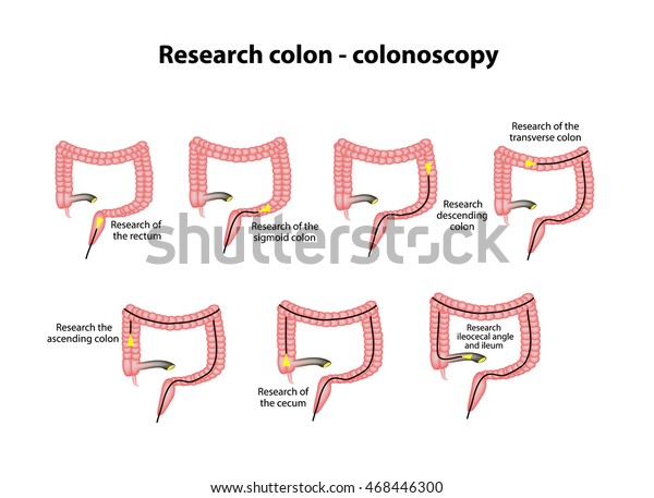 Colonoscopy Diagnosis Colon Infographics Vector Illustration ...