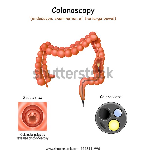 Colonoscopy Large Bowel Closeup Colonoscope Colorectal Stock Vector ...
